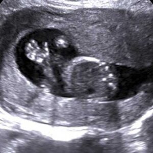 Gender Ultrasound - Spokane OBGYN